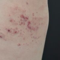 Eccema molluscatum Images - Altmeyers Encyclopedia - Department Dermatology