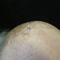 Cornu cutaneum Images - Altmeyers Encyclopedia - Department Dermatology