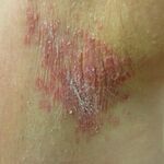 Candidosis intertriginous - Altmeyers Encyclopedia - Department Dermatology