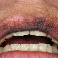 Argyrose Bilder - Altmeyers Enzyklopädie - Fachbereich Dermatologie