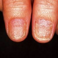 Lichen planus der Nägel Bilder - Altmeyers Enzyklopädie - Fachbereich ...