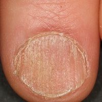 Nagel Bilder - Altmeyers Enzyklopädie - Fachbereich Dermatologie