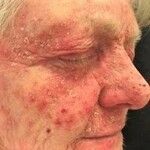 Steroid rosacea - Altmeyers Encyclopedia - Department Dermatology