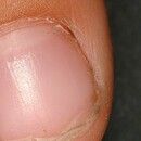 Maddrey score - Altmeyers Encyclopedia - Department Internal medicine