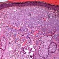 Elastose Bilder - Altmeyers Enzyklopädie - Fachbereich Dermatologie