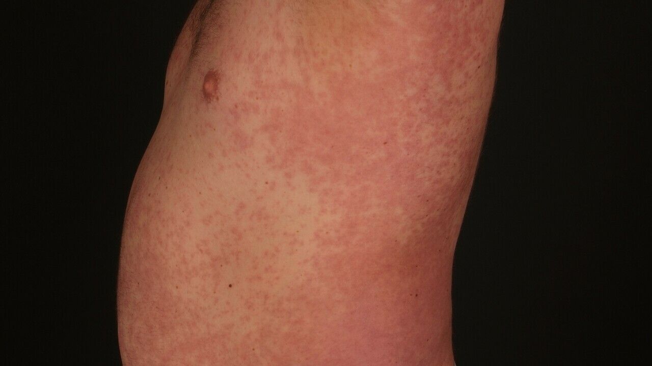 Cytomegalovirus Rash