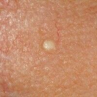 Zyste Bilder - Altmeyers Enzyklopädie - Fachbereich Dermatologie
