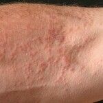 Follicular mucinosis - Altmeyers Encyclopedia - Department Dermatology