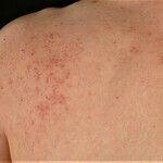 Follicular mucinosis - Altmeyers Encyclopedia - Department Dermatology