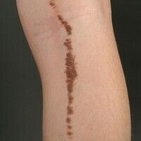 ILVEN Bilder - Altmeyers Enzyklopädie - Fachbereich Dermatologie