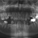 Steatocystoma multiplex - Altmeyers Encyclopedia - Department Dermatology