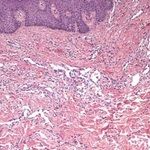 Targetoid hemosiderotic hemangioma - Altmeyers Encyclopedia ...