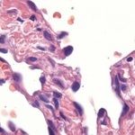 Targetoid hemosiderotic hemangioma - Altmeyers Encyclopedia ...