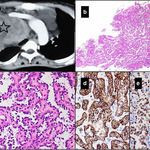 Retiform hemangioendothelioma - Altmeyers Encyclopedia - Department ...