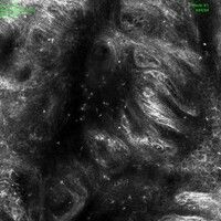 Adenoma sebaceum Bilder - Altmeyers Enzyklopädie - Fachbereich Dermatologie