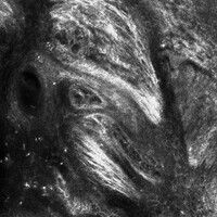 Angiofibrom (Übersicht) Bilder - Altmeyers Enzyklopädie - Fachbereich ...