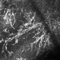 Tinea capitis (overview) Images - Altmeyers Encyclopedia - Department ...