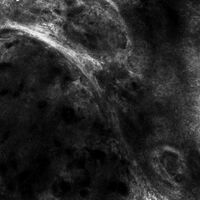 Talgdrüsen ektope Bilder - Altmeyers Enzyklopädie - Fachbereich ...