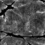 Lentigo simplex - Altmeyers Encyclopedia - Department Dermatology