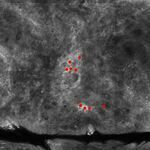 Lentigo simplex - Altmeyers Enzyklopädie - Fachbereich Dermatologie