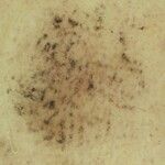 Lentigo simplex - Altmeyers Encyclopedia - Department Dermatology