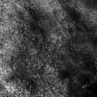 Lichen ruber mucosae Bilder - Altmeyers Enzyklopädie - Fachbereich ...