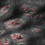 Lentigo simplex - Altmeyers Encyclopedia - Department Dermatology