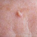 Macula - Altmeyers Encyclopedia - Department Dermatology