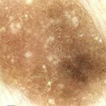 Keratosis seborrhoic (papillomatous type) - Altmeyers Encyclopedia ...