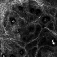 Talgdrüsenhyperplasie senile Bilder - Altmeyers Enzyklopädie ...