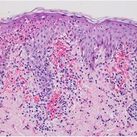 Pityriasis lichenoides (et varioliformis) acuta Images - Altmeyers ...