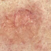 Talgdrüsenhyperplasie senile Bilder - Altmeyers Enzyklopädie ...