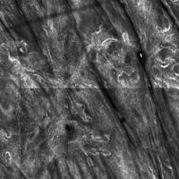 Basal cell carcinoma superficial Images - Altmeyers Encyclopedia ...