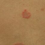 Pityriasis rosea - Altmeyers Encyclopedia - Department Dermatology