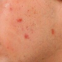 Acne papulopustulosa Images - Altmeyers Encyclopedia - Department ...