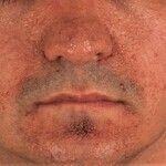 Adenoma sebaceum - Altmeyers Encyclopedia - Department Dermatology