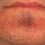 Adenoma sebaceum - Altmeyers Enzyklopädie - Fachbereich Dermatologie