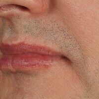 Lippenrandangiom Bilder - Altmeyers Enzyklopädie - Fachbereich Dermatologie