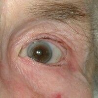 Arcus lipoides corneae Images - Altmeyers Encyclopedia - Department ...