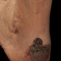 Angiokeratoma circumscriptum Images - Altmeyers Encyclopedia ...