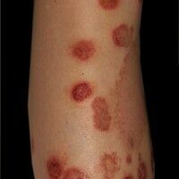 Ulcer of the skin (overview) Images - Altmeyers Encyclopedia ...