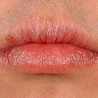Cheilitis simplex Images - Altmeyers Encyclopedia - Department Dermatology