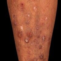 Chronic prurigo Images - Altmeyers Encyclopedia - Department Dermatology