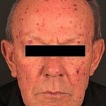 Crest syndrome - Altmeyers Encyclopedia - Department Dermatology