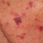 CREST-Syndrom - Altmeyers Enzyklopädie - Fachbereich Dermatologie