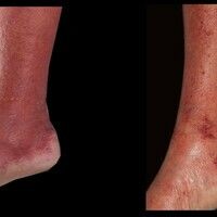 Erysipel Bilder - Altmeyers Enzyklopädie - Fachbereich Dermatologie