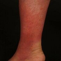 Erysipel Bilder - Altmeyers Enzyklopädie - Fachbereich Dermatologie