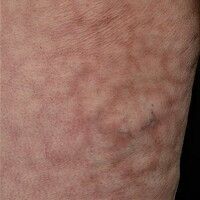 Livedo racemosa (overview) Images - Altmeyers Encyclopedia - Department ...