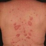 Erythema anulare centrifugum - Altmeyers Encyclopedia - Department ...
