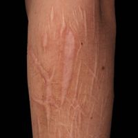 Blaschko lines Images - Altmeyers Encyclopedia - Department Dermatology